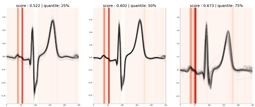 Deep Learning in Cardiology: Understanding Interpretability | Cardiologs Deep Learning in Cardiology: Understanding Interpretability | Cardiologs